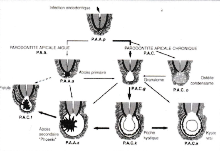 Les lésions inflammatoires péri -apicales d'origine endodontique ...