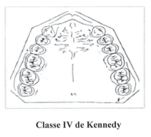 Edentements et classification - CoursDentaires.com