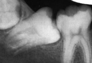 Les anomalies dentaires d’origine non carieuse et non traumatique ...