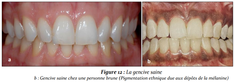 Le Parodonte / Parodontologie - CoursDentaires.com