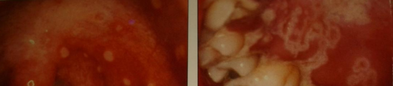 Affections vésiculeuses de la muqueuse buccale / Pathologie et ...