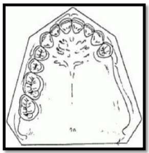 Classification des édentements partiels / Prothèse Dentaire ...