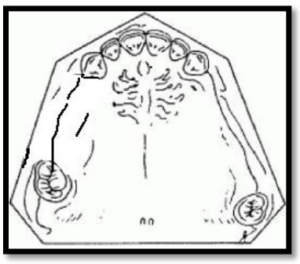 Classification des édentements partiels / Prothèse Dentaire ...