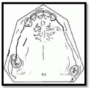 Classification des édentements partiels / Prothèse Dentaire ...