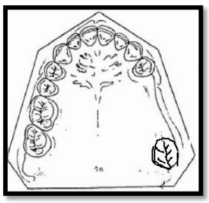 Classification des édentements partiels / Prothèse Dentaire ...