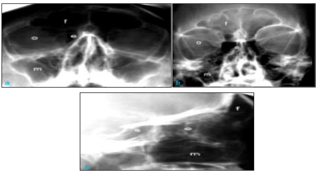 La Rétro-alvéolaire, Radiologique Dentaire - CoursDentaires.com